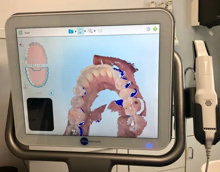 Công nghệ scan răng 3d: tiến bộ lớn trong lĩnh vực nha khoa hiện đại